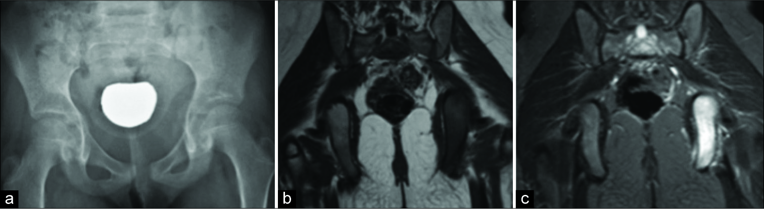 Isolated Ischial Lesions Demographics And Imaging Features Indian